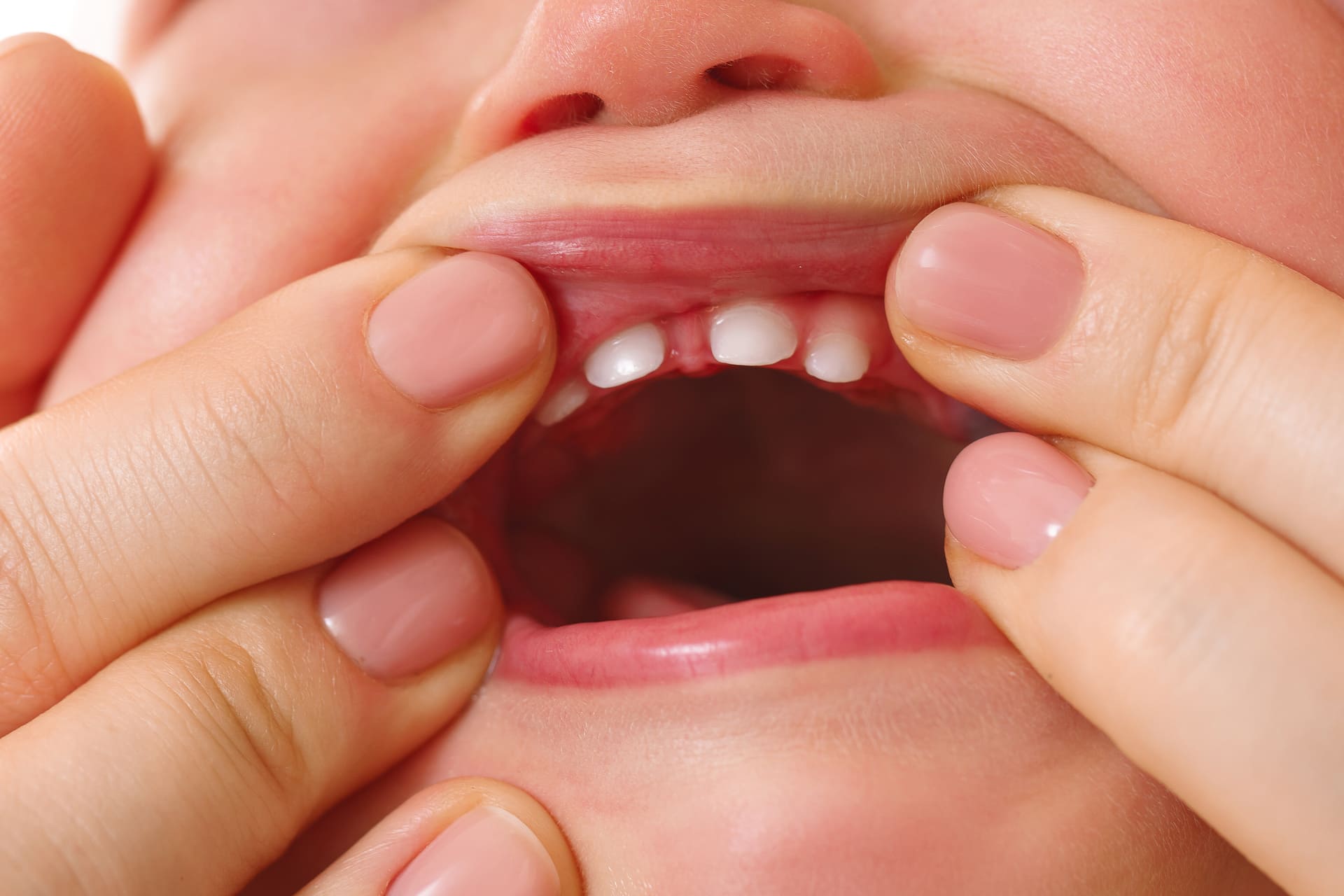 Lippenbändchen beim Baby gerissen: Das musst du wissen - Das ...