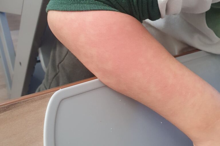 Ringelröteln: Kann man die Krankheit mehrmals bekommen? - Das ...